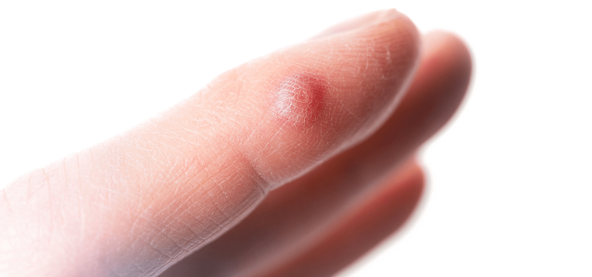 Warts – Dr. Chakor Homeopathy
